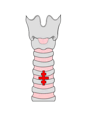 slit type tracheostomy