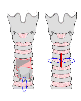 tracheal resection procedure